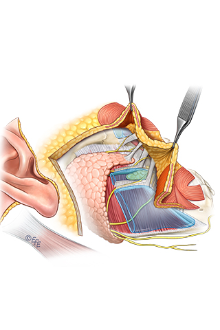 facelift - Deep Plane Facelift Dr. Min-Hee Ryu