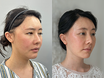 facelift - Deep Plane Facelift Dr. Min-Hee Ryu