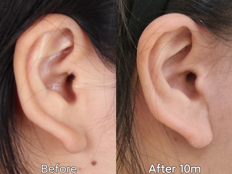 Dr. Ryu's Deep Plane Facelift Key Features Invisible incisional line ...