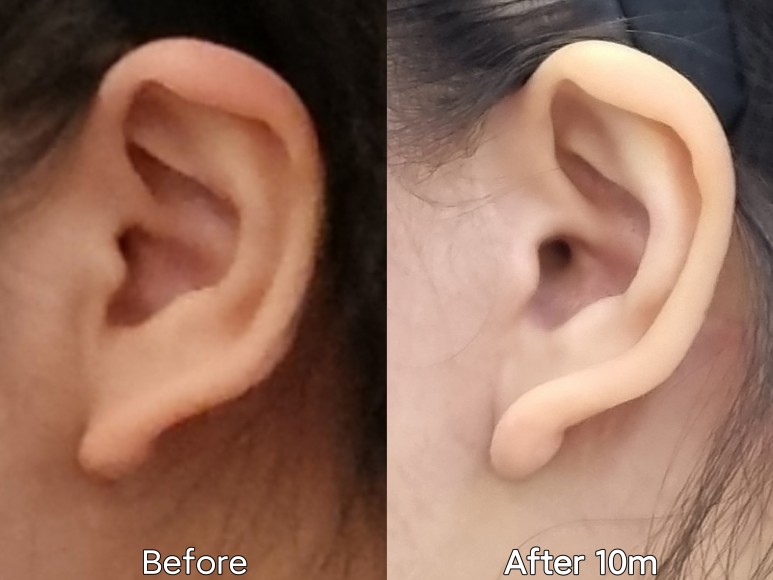 Dr. Ryu's Deep Plane Facelift Key Features Invisible incisional line ...