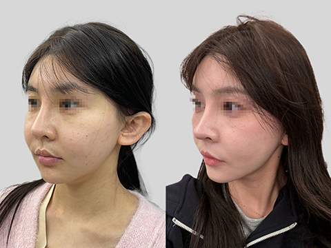 facelift - Deep Plane Facelift Dr. Min-Hee Ryu