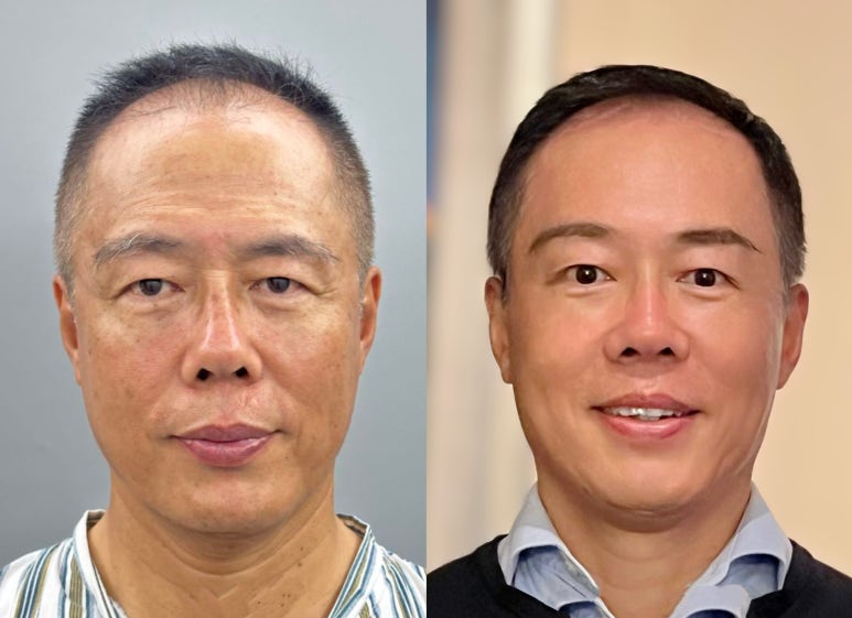 Dr. Ryu’s deep plane facelifting : 62-year-old man underwent forehead ...
