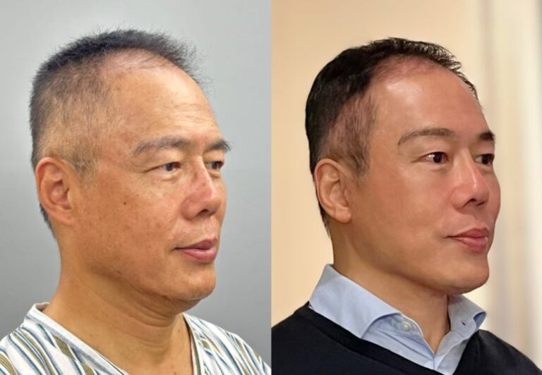 Dr. Ryu’s deep plane facelifting : 62-year-old man underwent forehead ...