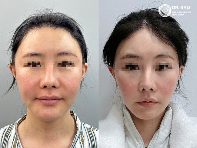 face Lifting Result best face lift korean face lift face and neck lift ...