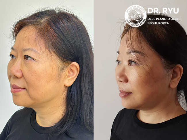 face Lifting Result best face lift korean face lift face and neck lift ...
