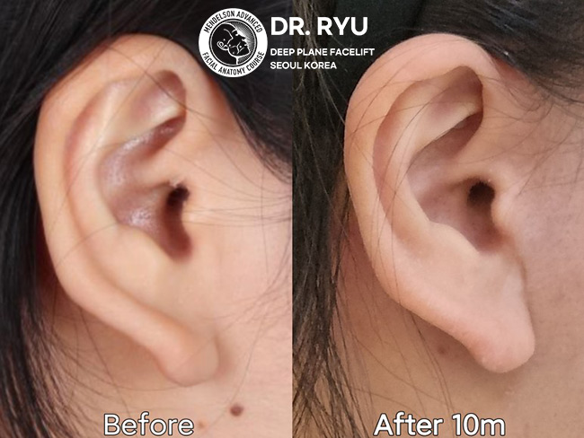 face Lifting Result best face lift korean face lift face and neck lift ...