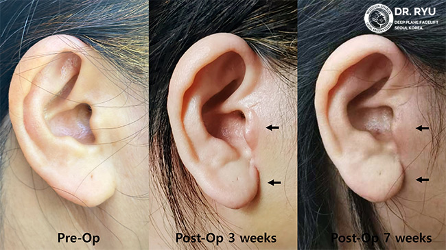 face Lifting Result best face lift korean face lift face and neck lift ...