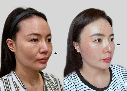 facelift - Deep Plane Facelift Dr. Min-Hee Ryu