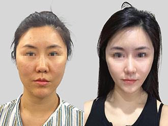 facelift - Deep Plane Facelift Dr. Min-Hee Ryu
