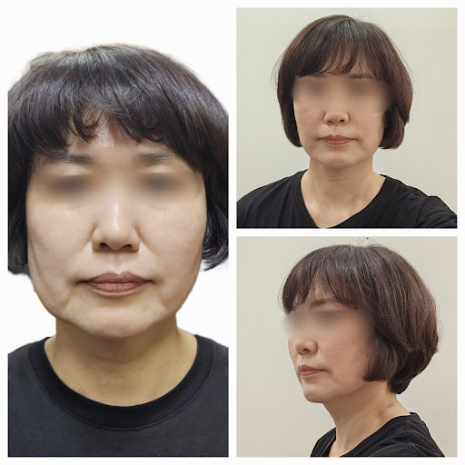 facelift - Deep Plane Facelift Dr. Min-Hee Ryu